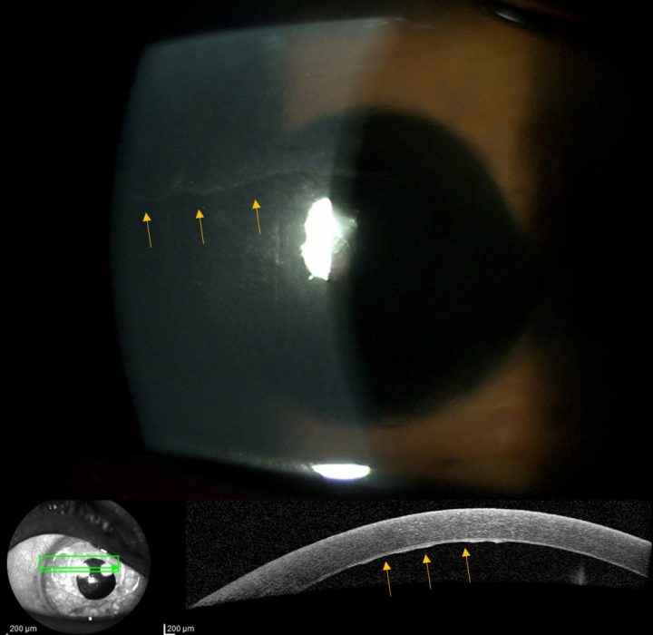 White lines in the Cornea, red lines on the OCT - GRUPO PORTUGUÊS DE ...